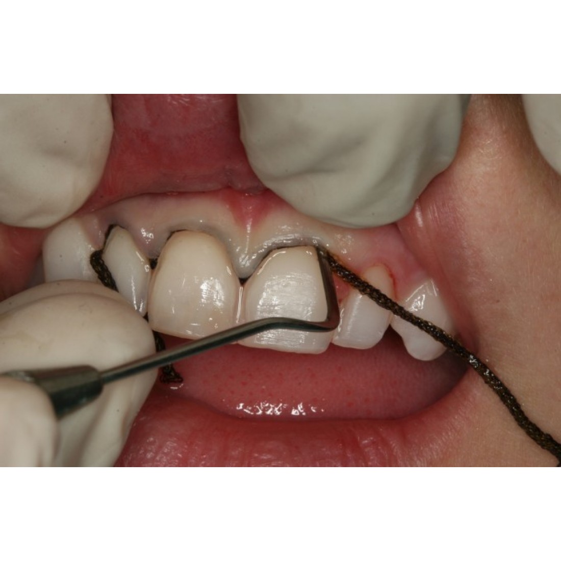 Buy Retraction Cord Packer WALDENT Online at Lowest Best ...