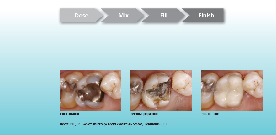 Buy Cention N Big Pack Ivoclar-Vivadent Online at Lowest ...